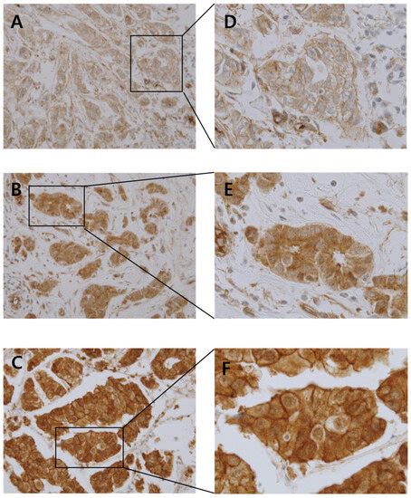 Effects Of Cortactin Expression On Prognosis In Patients With Breast Cancer