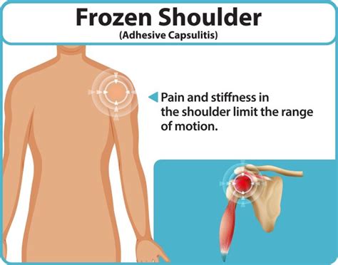 Shoulder Anatomy And Adhesive Capsulitis Vector Image