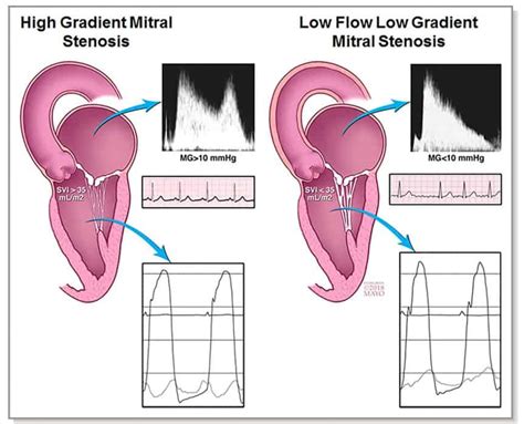 Estenose Mitral Com Baixo Gradiente Um Olhar Mais Amplo Blog Ecope