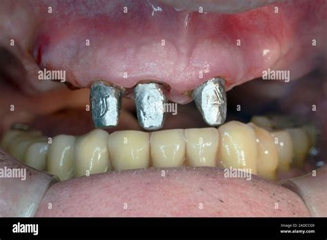 Upper Incisor Teeth Of A 70 Year Old Female Patient That Have Been