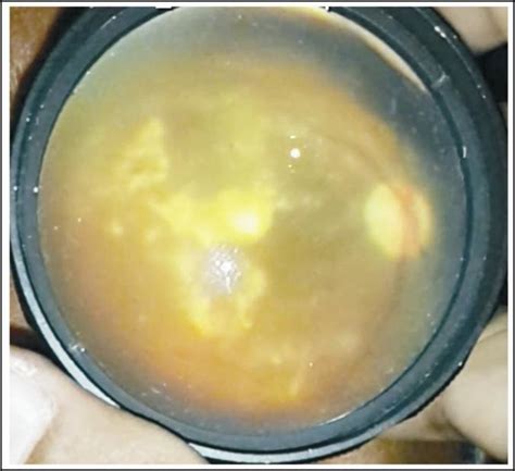 Massive Plaque Exudative Maculopathy Download Scientific Diagram