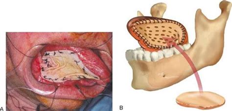 Management Of The Partial Glossectomy Defect Split Thickness Skin