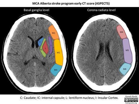 Discover 20 Ct Head And Brain Anatomy Ideas Basal Ganglia Neurology