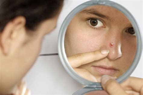 How To Get Rid Of A Pimple On The Nose