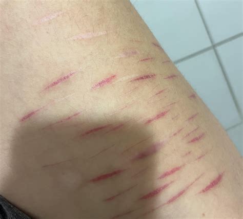 Tw Sh Scars How Long Will These Take To Turn White Rscars