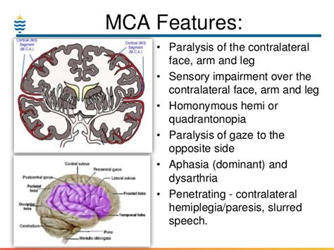 Stroke Ischemic Mdm Ty Dot Phrase