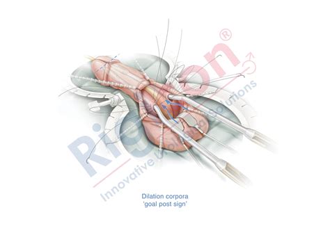 Conticlassic® The New Artificial Urinary Sphincter From Rigicon