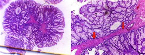 Gastrointestinal And Liver Histology Pathology Atlas Colon Hamartomatous Polyp Including