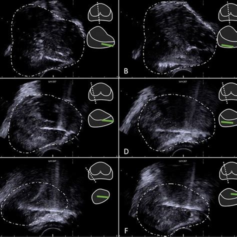 Transperineal Prostate Biopsy Preparation With Transrectal Biopsy Download Scientific Diagram