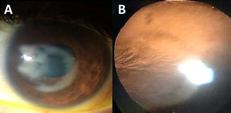 Nummular Keratitis Recent Advances In The Diagnosis And Management Of