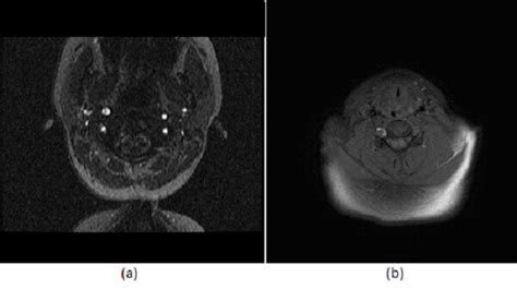 Carotid Artery Dissection Mra Docneuro