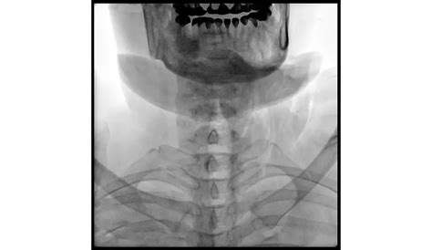 Philips Zenition 30 Mobile C Arm With Flat Detector