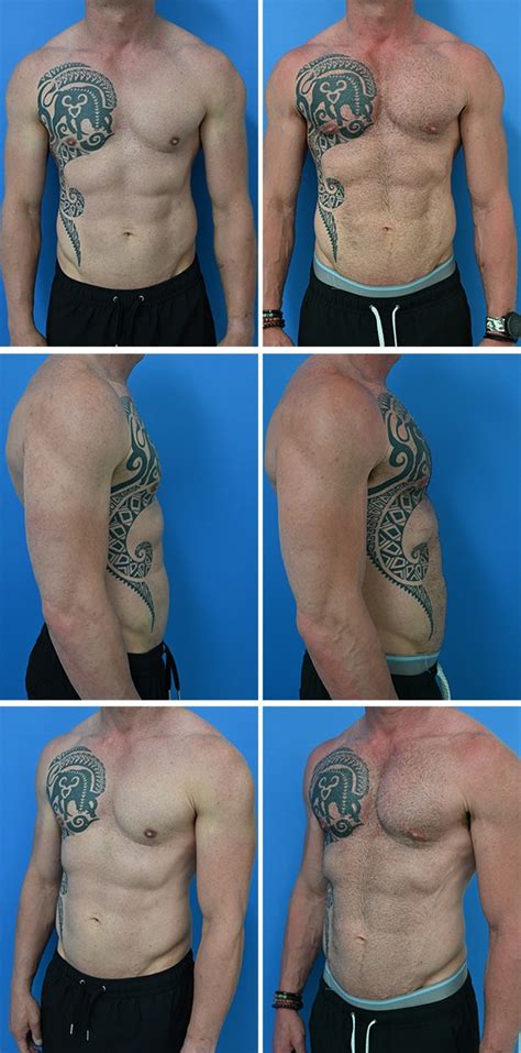 Male Pectoral Implants Dr G Cosmetic Surgery