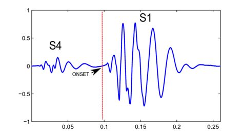 Onset Detection Of S1 In A Pcg Waveform Using The Algorithm It Is Download Scientific Diagram