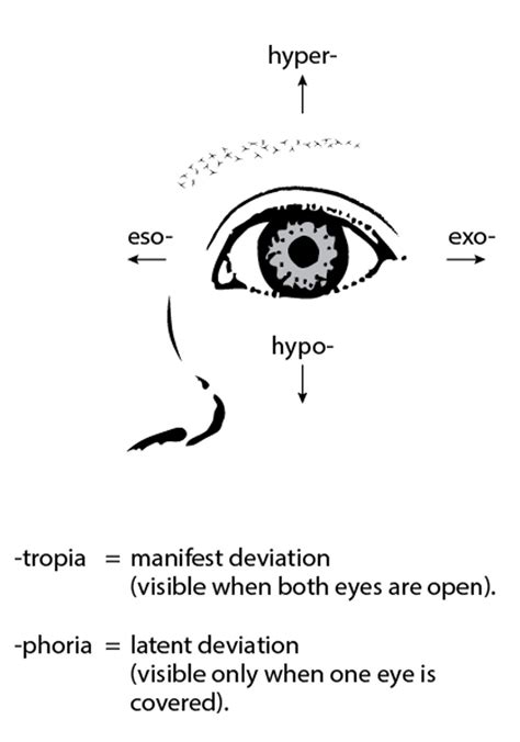 Imageocular Deviations In Strabismus Msd Manual Professional Edition