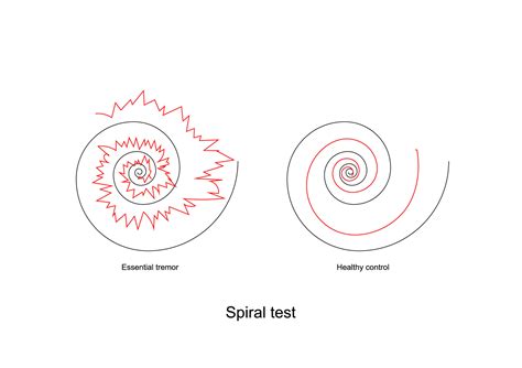 Essential Tremor Versus Healthy Control Spiral Test 46974465 Vector Art