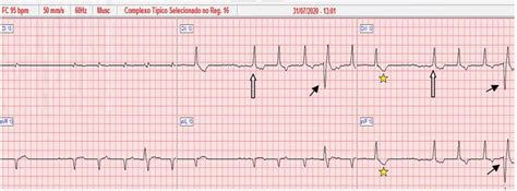 Six Lead Electrocardiogram Presenting Af Junctional Escape Beat Open Download Scientific