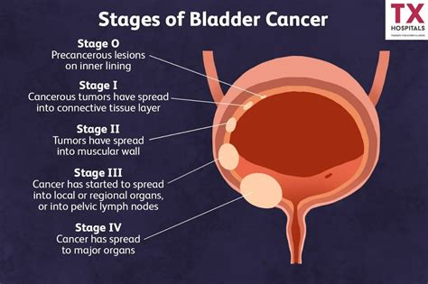 Bladder Cancer Risk Factors And Treatment Options TX Hospitals
