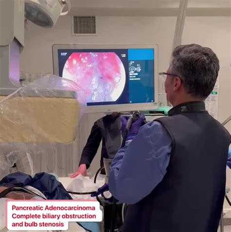 Video Resul Kahraman On Linkedin Pancreas Carcinoma Cholangiocarcinoma Eus