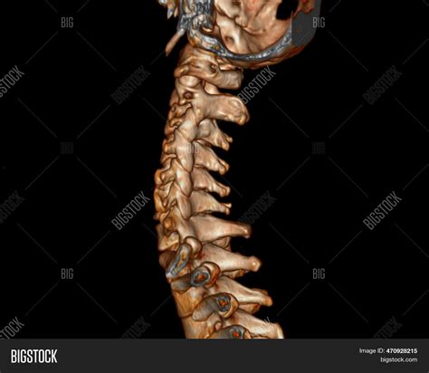 Imagen Y Foto Ct Scan C Spine Prueba Gratis Bigstock