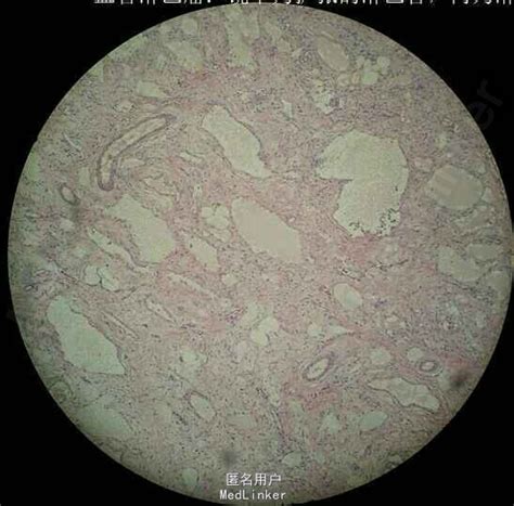 披裂血管淋巴管瘤