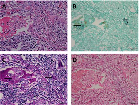 Cryptococcus Histology Cryptococcus Histology