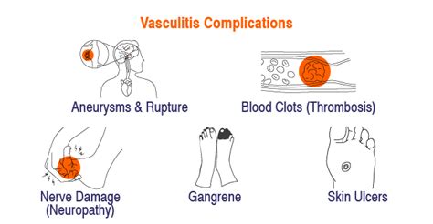 Vasculitis Types Causes Symptoms Diagnosis And Treatment Options