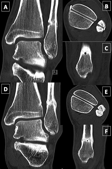 A C Ct Scans Of Stress Reaction At The Fibula Suture Button Drill Download Scientific Diagram