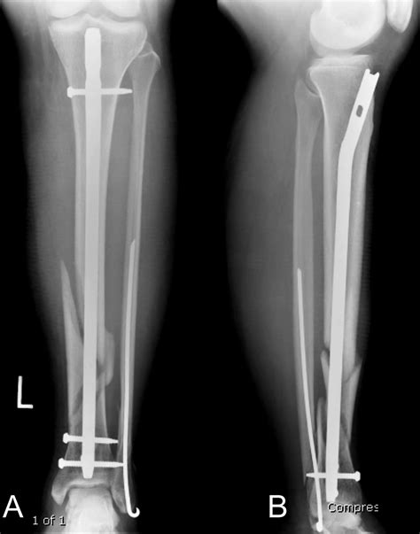 Intramedullary Rod Tibia