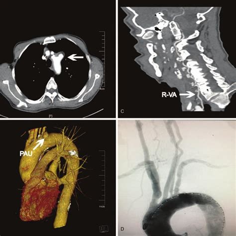 A Type B Aortic Dissection With Descending Thoracic Aortic Dissection