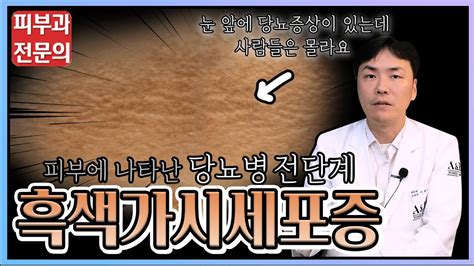 까딱하면 당뇨 당뇨병 전단계 때 나타나는 피부질환 흑색가지세포증 치료방법 연세에이엔비피부과 이해진 원장 Youtube