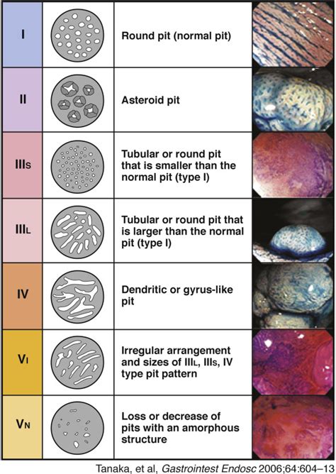 Endoscopic Recognition And Management Strategies For Malignant Colorectal Polyps Endoscopic Recognition And Management Strategies For Malignant Colorectal Polyps