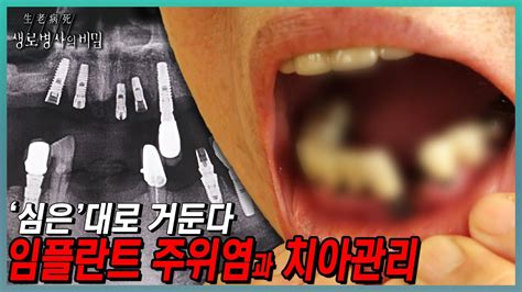 비싼 임플란트가 골칫덩이로😫 입 안의 공포 임플란트 주위염🦷 철저한 관리로 지키는 치아건강 Kbs 231213 방송 Youtube
