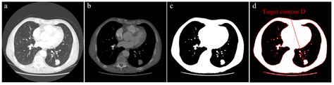 An Automatic Segmentation Method For Lung Tumor Based On Improved Region Growing Algorithm