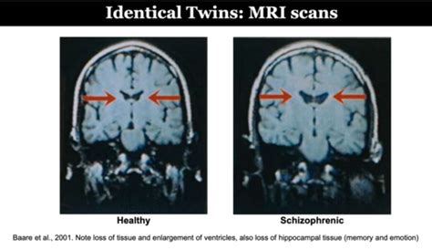 Schizophrenia Brain Ventricles