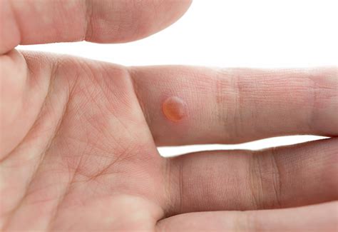 いぼ水いぼ老人性いぼウイルス性のいぼ清瀬の皮膚科なら清瀬皮フ科形成外科クリニック