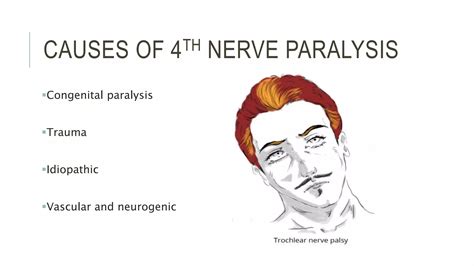 Trochlear Nerve PPTX