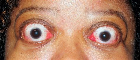 Tepezza First Drug For Thyroid Eye Disease Biopharmanews