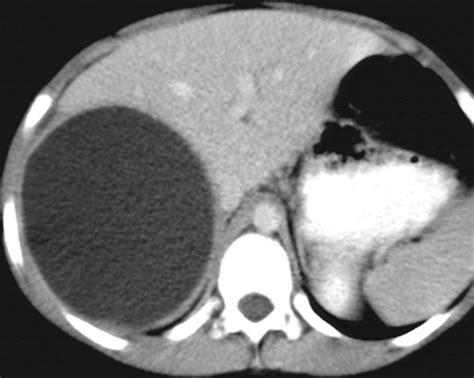 Liver Atlas Diagnosis Echinococcosis Cystic Hydatid