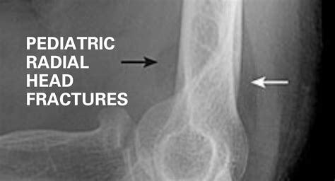 Emergency Medicine Educationpediatric Radial Head Fractures Special Considerations