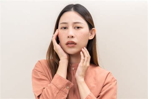 Hyperpigmentation Vs Melasma Whats The Difference Dr Jason Emer Reviews