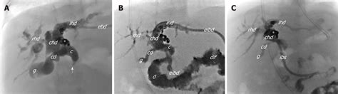 cholangiogram a cholangiogram from the external biliary drainage