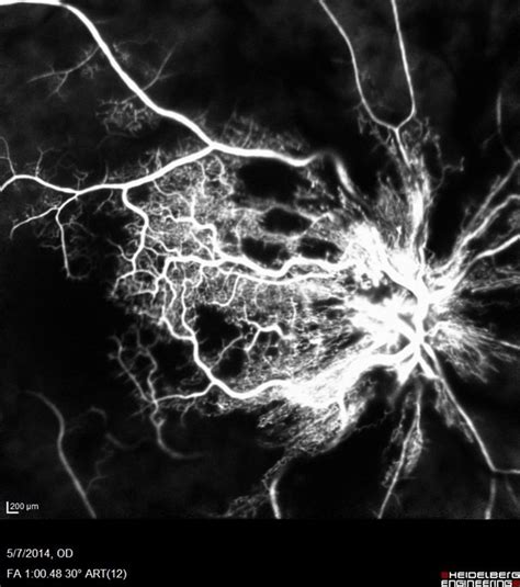 Early Phase Of Fa In A Case Of Combined Crao And Crvo Retina Image Bank