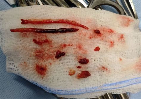 Acute Limb Ischemia Case Profile And Clinical Progression Surgical Procedure