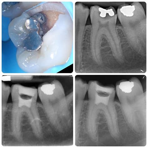 Pulpotomy Belfast Endodontics