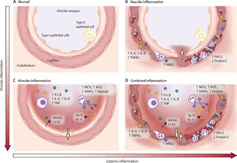 Respiratory Distress Syndrome Histology