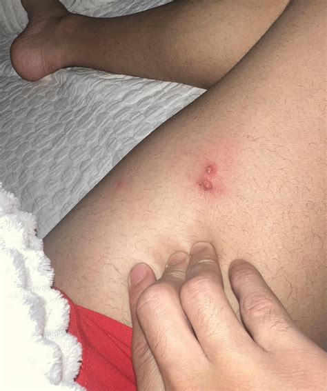 Causes Of Scalp Folliculitis R Folliculitis