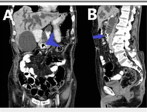 Figure 2 From A Rare Presentation Of Duodenal Diverticulum Causing Obstructive Jaundice Lemmel