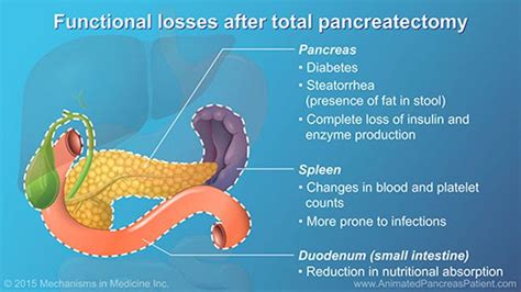 Distal Pancreatectomy