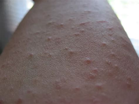 Molluscum Contagiosum A Possible Sexually Transmitted Infection